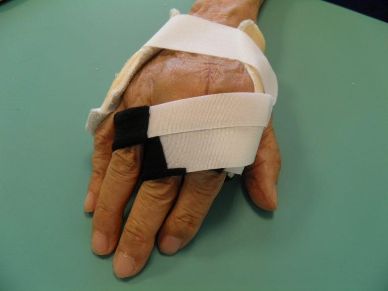 Orthèses – Chirurgie de la main à Toulouse